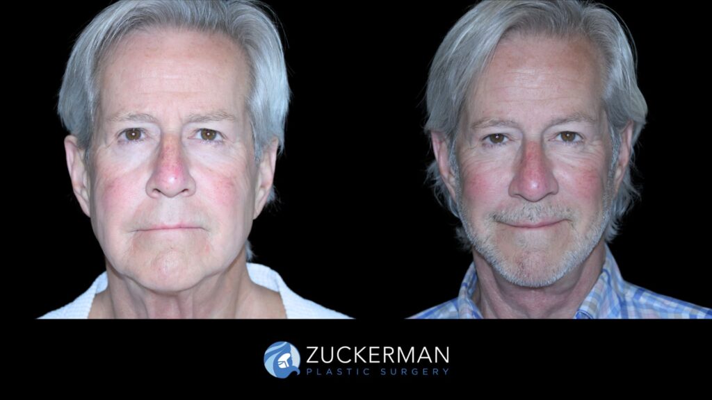 Neck Lift Archives | Zuckerman Plastic Surgery