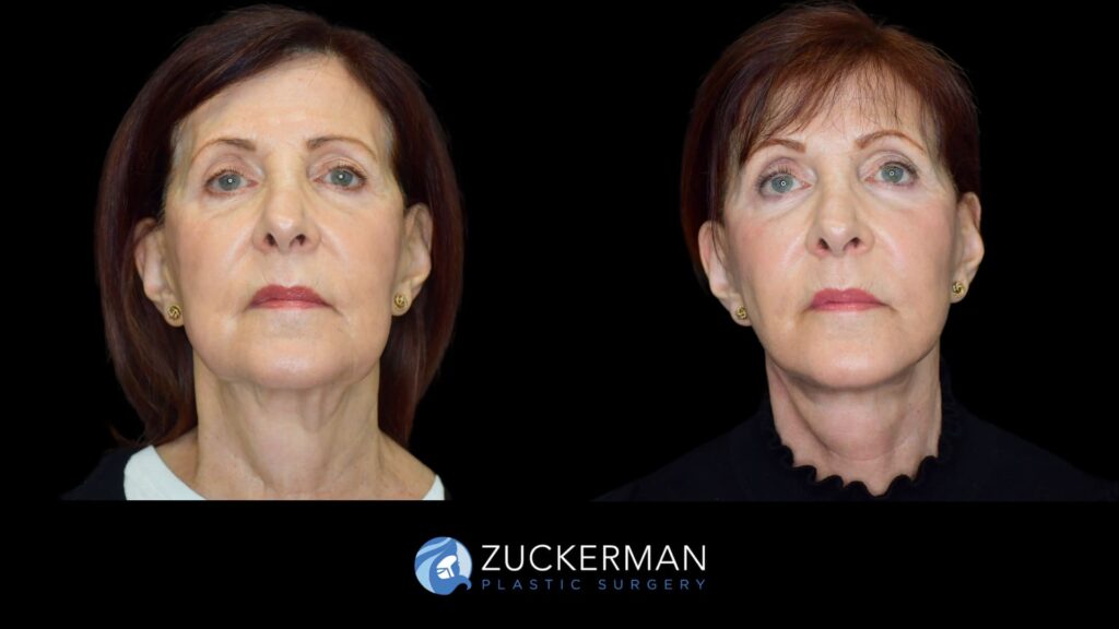 Neck Lift Archives | Zuckerman Plastic Surgery
