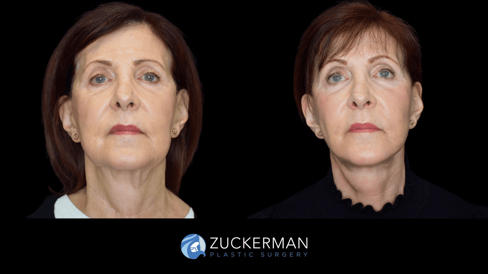 Neck Lift Archives | Zuckerman Plastic Surgery