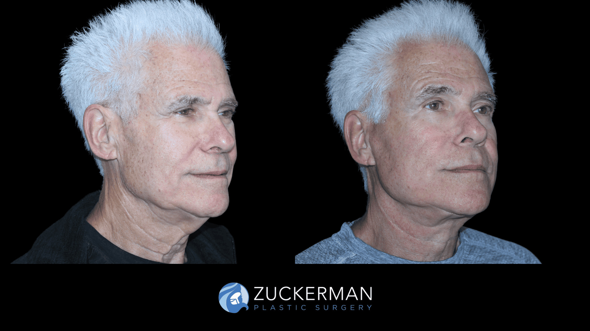 Neck Lift Archives | Zuckerman Plastic Surgery